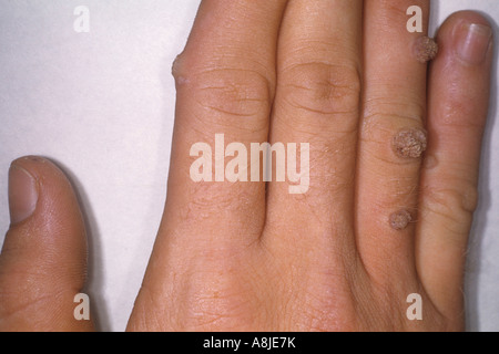 Verrue commune causée par le virus HPV Photo Stock - Alamy