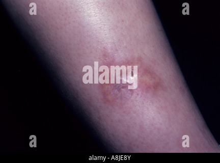 La nécrobiose lipoidica diabeticorum est une éruption cutanée qui se ...