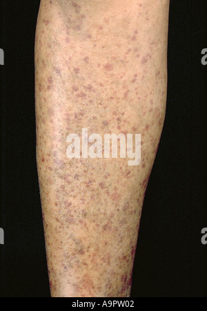 Vascularite - éruption Vascularite Photo Stock - Alamy