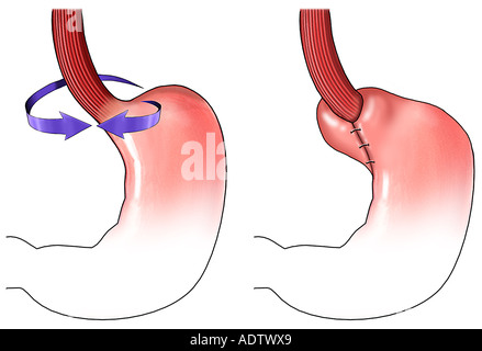 La chirurgie de la fundoplicature de Nissen Photo Stock - Alamy