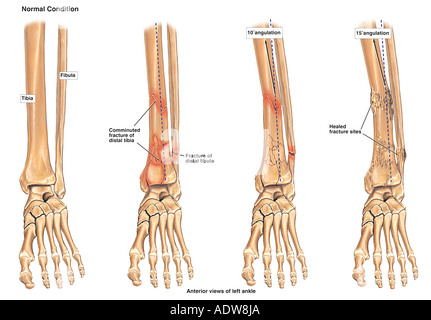 Les fractures de la jambe (tibia et péroné) avec fixation chirurgicale Photo Stock - Alamy