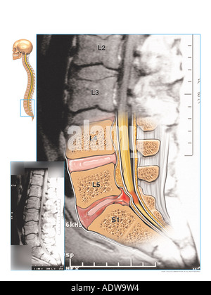 L5-S1 Hernie discale lombaire avec Discectomie chirurgicale et de ...