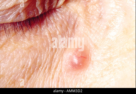 Un carcinome baso-cellulaire sur le visage de l'homme plus âgé avant ...