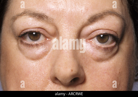 Une femme avec la maladie de Basedow (maladie de Basedow-Graves Banque ...