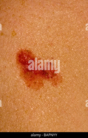 Le carcinome basocellulaire superficiel Photo Stock - Alamy