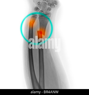 X-ray montrant une fracture de la partie distale du radius et cubitus ...