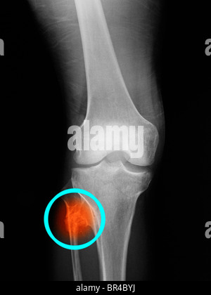 Une radiographie montrant une fracture du tibia et du péroné de la ...