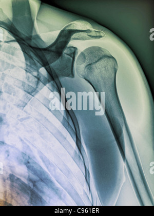 L'épaule normale. Radiographie de l'épaule gauche en bonne santé d'un ...