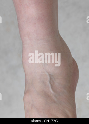 La cheville enflée de femme Photo Stock - Alamy