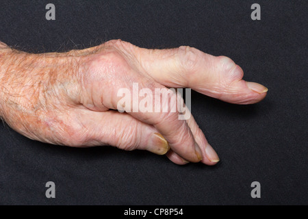 Un homme âgé avec un kyste ganglionnaire sur son doigt Photo Stock - Alamy
