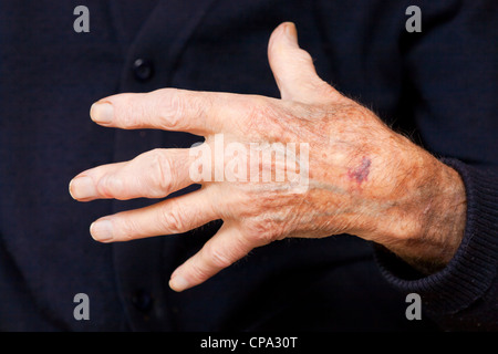Un homme âgé avec un kyste ganglionnaire sur son doigt Photo Stock - Alamy