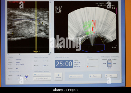 Échographie DE LA PROSTATE CANCER Photo Stock - Alamy