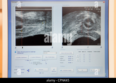 Échographie DE LA PROSTATE CANCER Photo Stock - Alamy