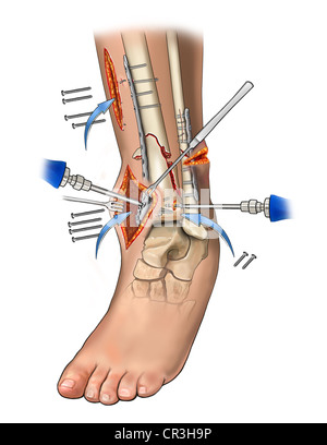 Fracture du péroné et du tibia Fixations Photo Stock - Alamy