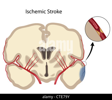Illustration médicale d'un accident vasculaire cérébral ischémique ...