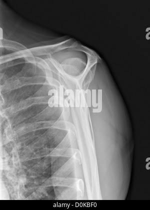 Une radiographie de l'épaule de l'humérus (montrant avant l'os du bras ...