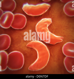 La drépanocytose la drépanocytose la drépanocytose ou trouble sanguin ...