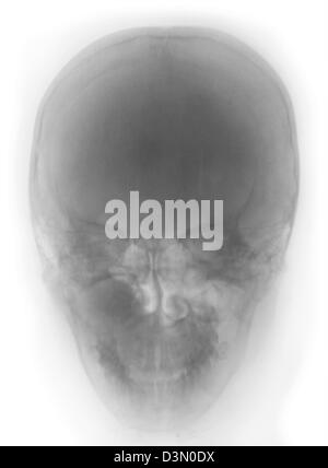 X-ray montrant une tumeur du sinus maxillaire Photo Stock - Alamy