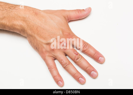 La main de l'homme couvert de cloques causées par la cryochirurgie ...