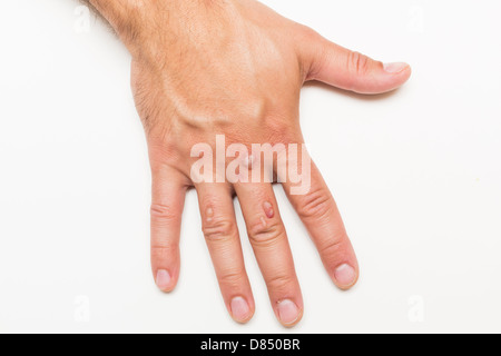 La main de l'homme couvert de cloques causées par la cryochirurgie ...