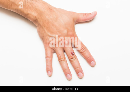 La main de l'homme couvert de cloques causées par la cryochirurgie ...