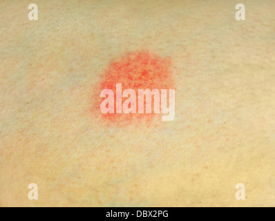 Morsure avec des taches rouges sur la peau, Close up Banque D'Images ...