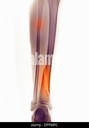 Une radiographie montrant une fracture du tibia et du péroné de la ...