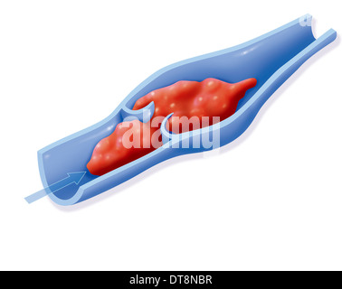 Thrombose veineuse profonde illustration anatomie Vecteurs Et ...