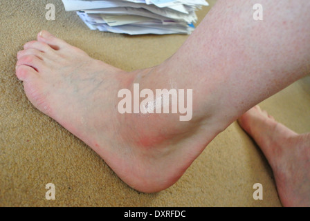 La cheville enflée de femme Photo Stock - Alamy