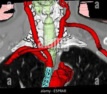 À partir de la reconstruction 3D et l'angiographie CT scanner du crâne ...