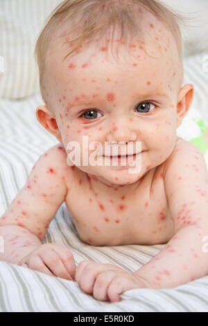 La varicelle sur un bébé de 4 mois Photo Stock - Alamy