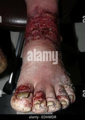 Cancer de la peau. Gros plan du pied d'un homme de 60 ans atteint d'un ...