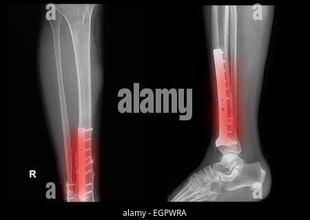 X-ray image fracture de jambe (tibia )avec plaque et vis de l'implant ...