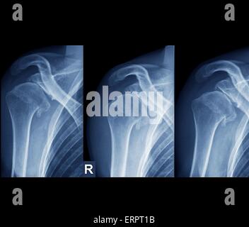 Radiographies de l'épaule droite d'un patient de 36 ans qui a, à ...