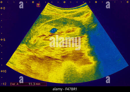 Kyste rénal, échographie Photo Stock - Alamy