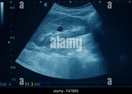 Kyste rénal, échographie Photo Stock - Alamy