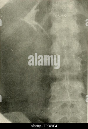 (Pyelo-ureterography La pyélographie) une étude de l'anatomie normale ...
