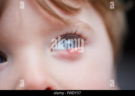 Un orgelet externe ou sty aussi, orgelet est une infection des glandes ...
