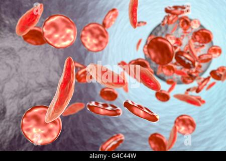 La drépanocytose la drépanocytose la drépanocytose ou trouble sanguin ...