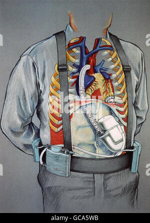 UN NOUVEAU DISPOSITIF CARDIAQUE, CONNU SOUS LE NOM DE DISPOSITIF D ...