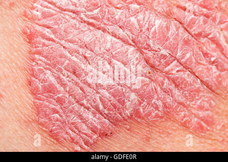 Santé de la peau le psoriasis maladie maladie maladie santé main macro ...