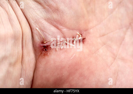 Points solubles dans une main une plaie chirurgicale pour corriger un ...