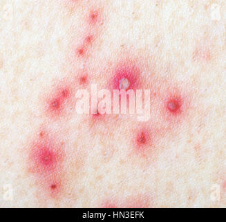 Détail de la peau avec de l'herpès zoster (zona Photo Stock - Alamy