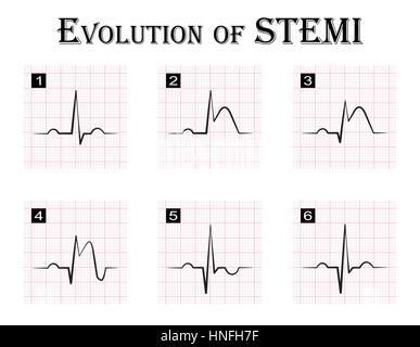 L'ECG de l'infarctus du myocarde ST STEMI ( ) et le détail de l'ECG ( P ...