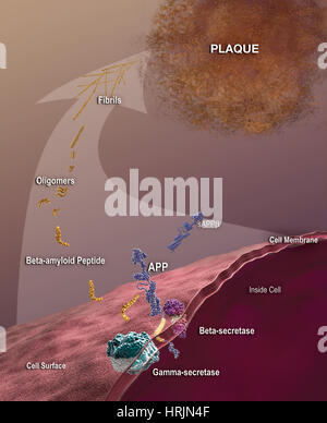 La maladie d'Alzheimer. Illustration d'ordinateur de plaques amyloïdes ...