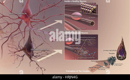 La maladie d'Alzheimer, la dégénérescence neurofibrillaire Photo Stock ...