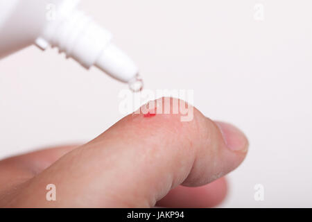 Doigt rouge gonflée en main selon piqûre d'insecte Photo Stock - Alamy