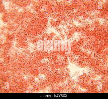 Frottis sanguin sous microscope présente des neutrophiles et globules ...