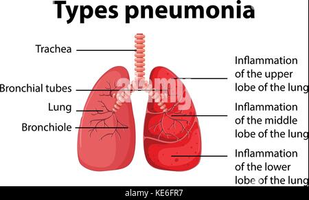 Anatomie humaine montrant une illustration de la pneumonie Image ...