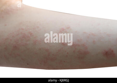 Éruptions cutanées et de la peau sur les bras, isolé sur fond blanc ...